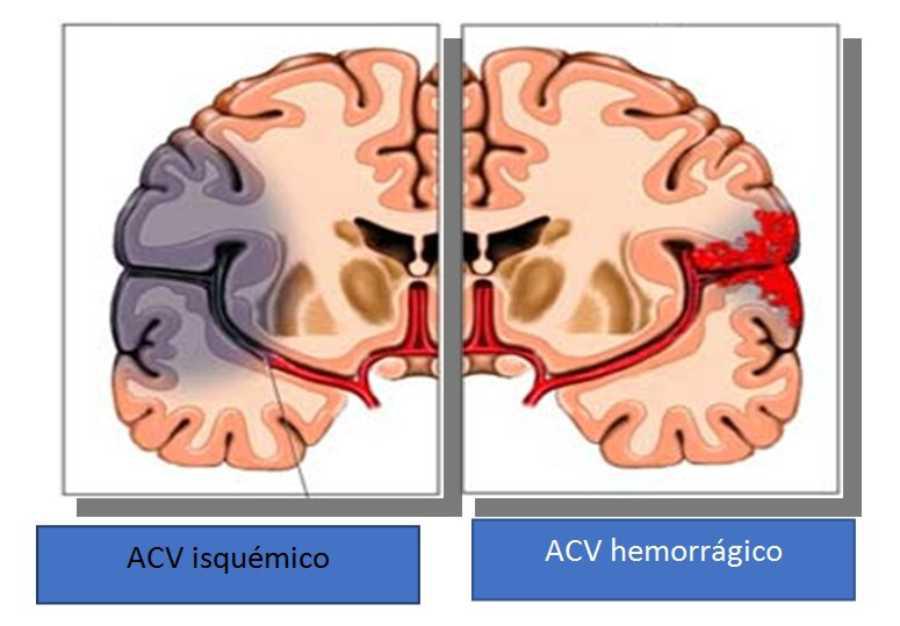 29 de octubre: Día Mundial del ACV